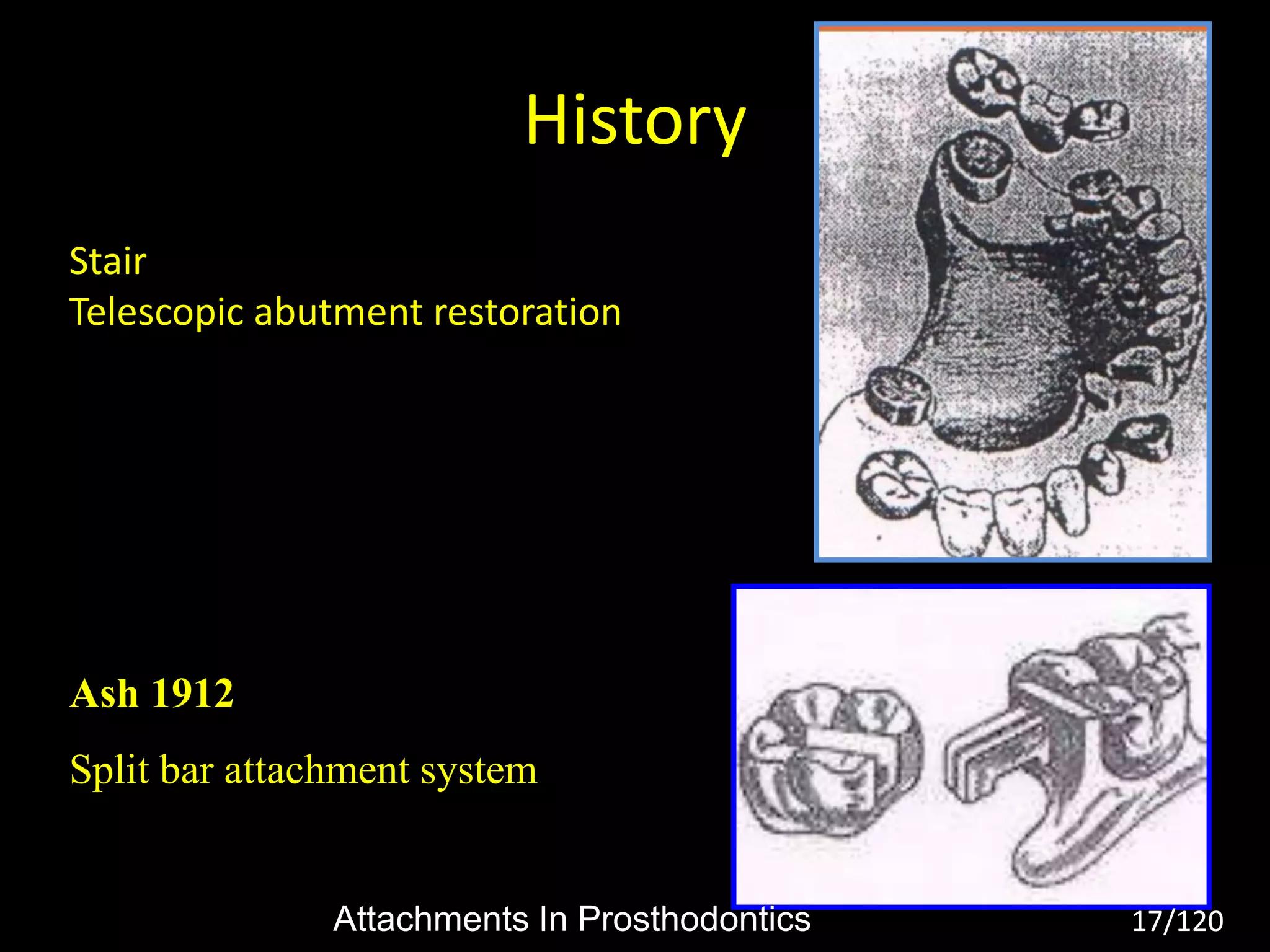 Attachments In Prosthodontics | PPTX