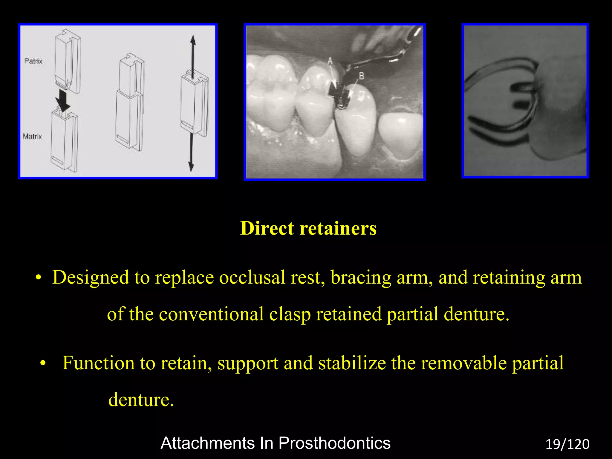 Attachments In Prosthodontics | PPTX