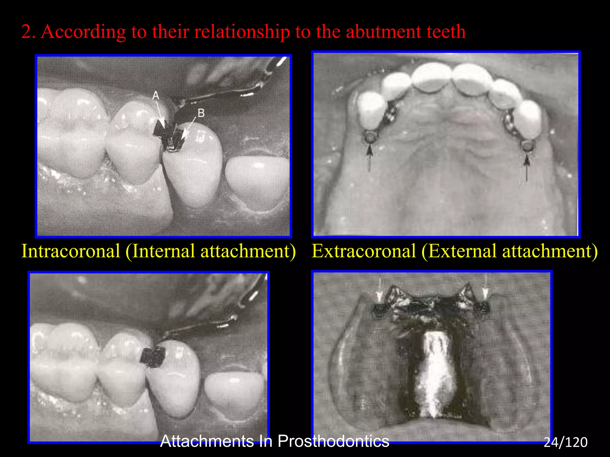 Attachments In Prosthodontics | PPTX
