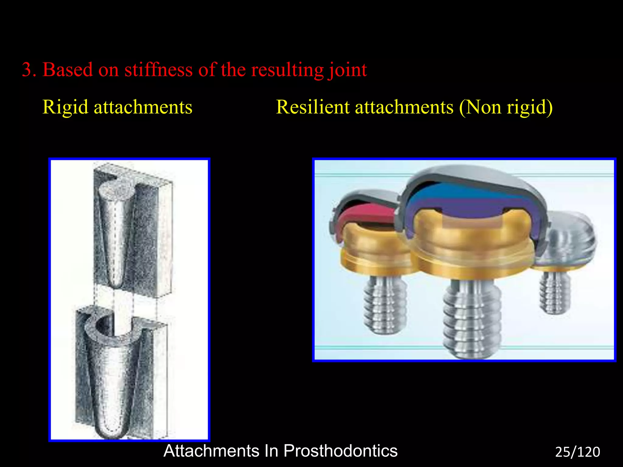 Attachments In Prosthodontics | PPTX