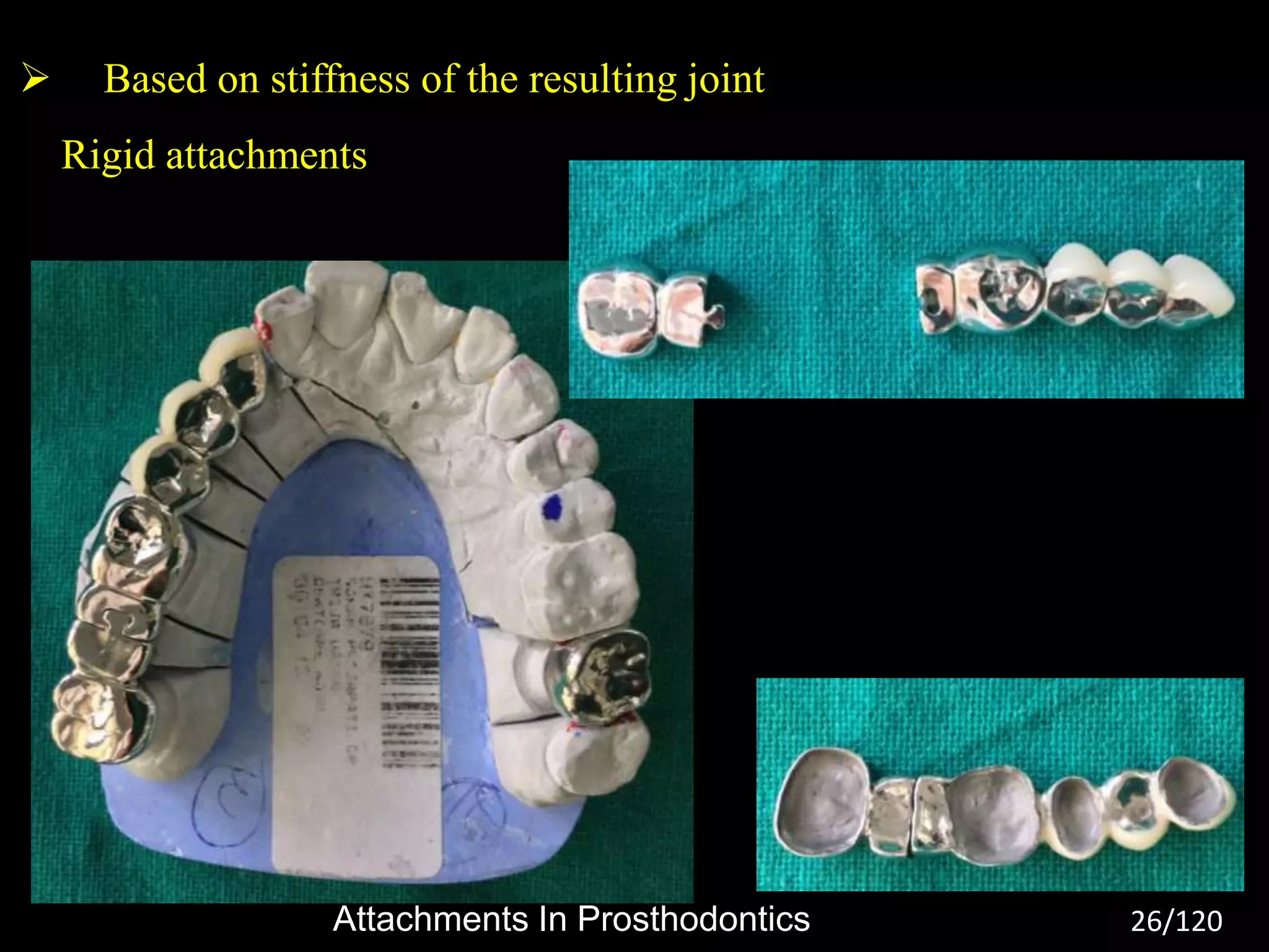 Attachments In Prosthodontics | PPTX