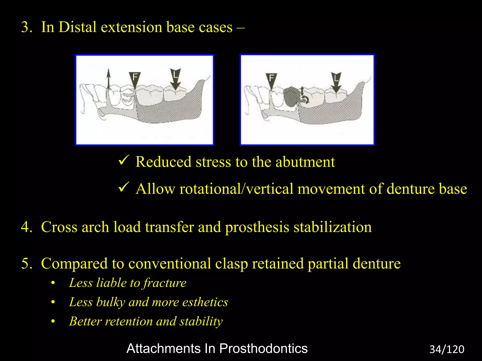 Attachments In Prosthodontics | PPTX