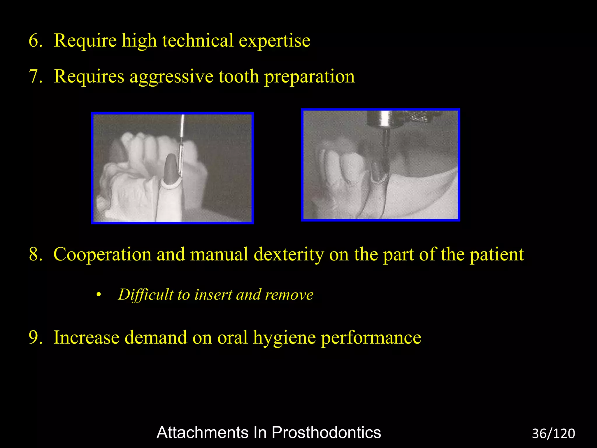 Attachments In Prosthodontics | PPTX