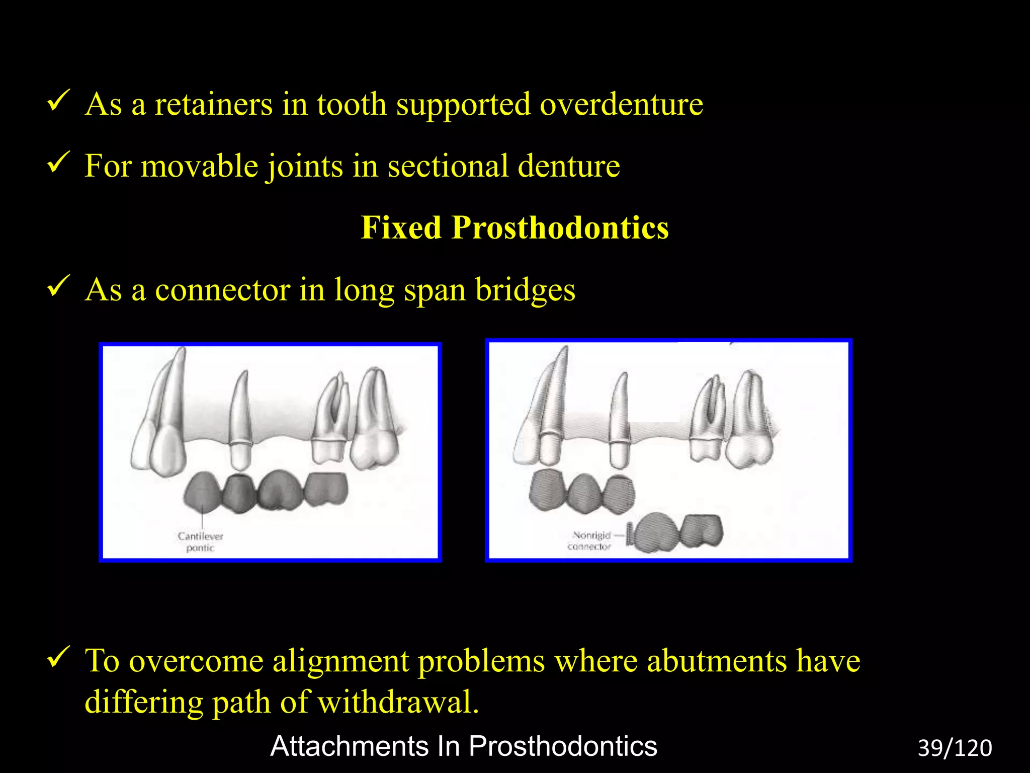 Attachments In Prosthodontics | PPTX