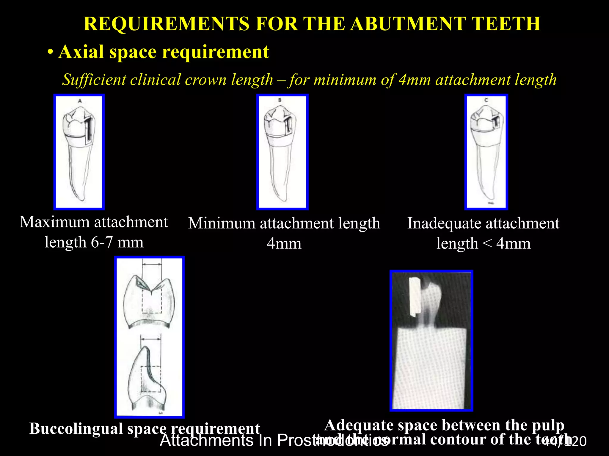 Attachments In Prosthodontics | PPTX