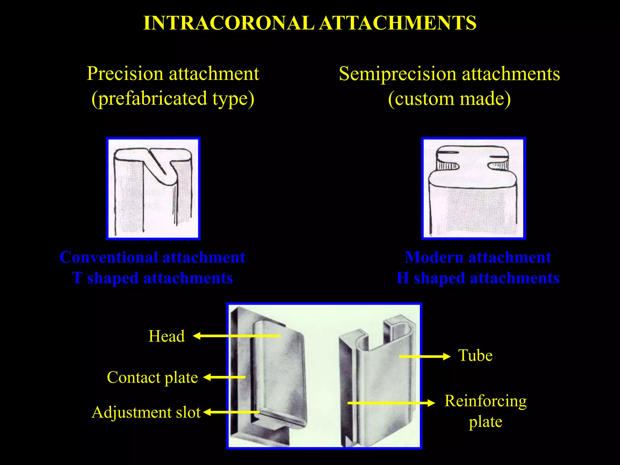 Attachments In Prosthodontics | PPTX