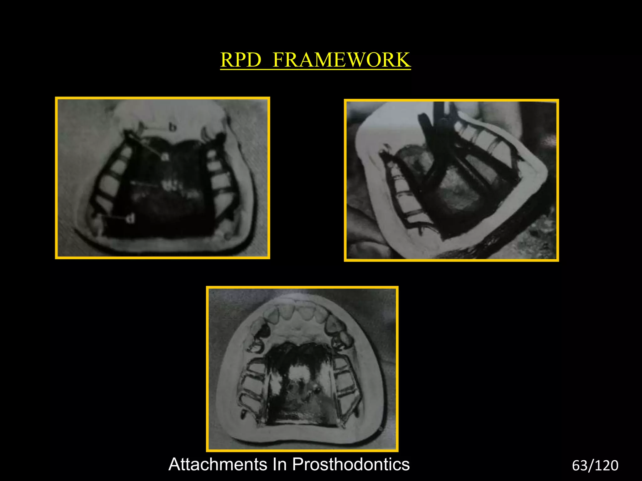 Attachments In Prosthodontics | PPTX