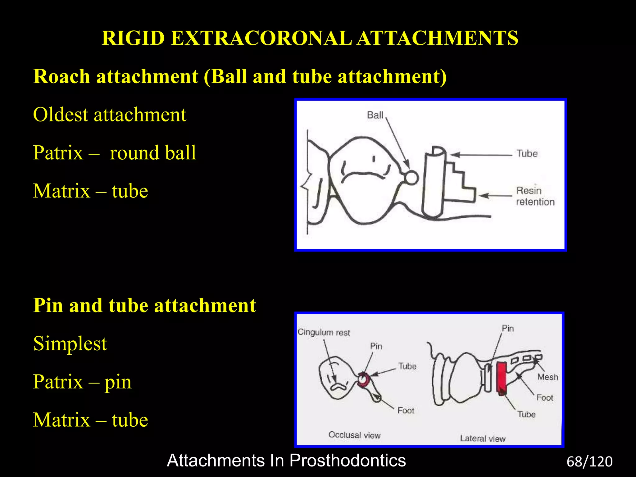 Attachments In Prosthodontics | PPTX
