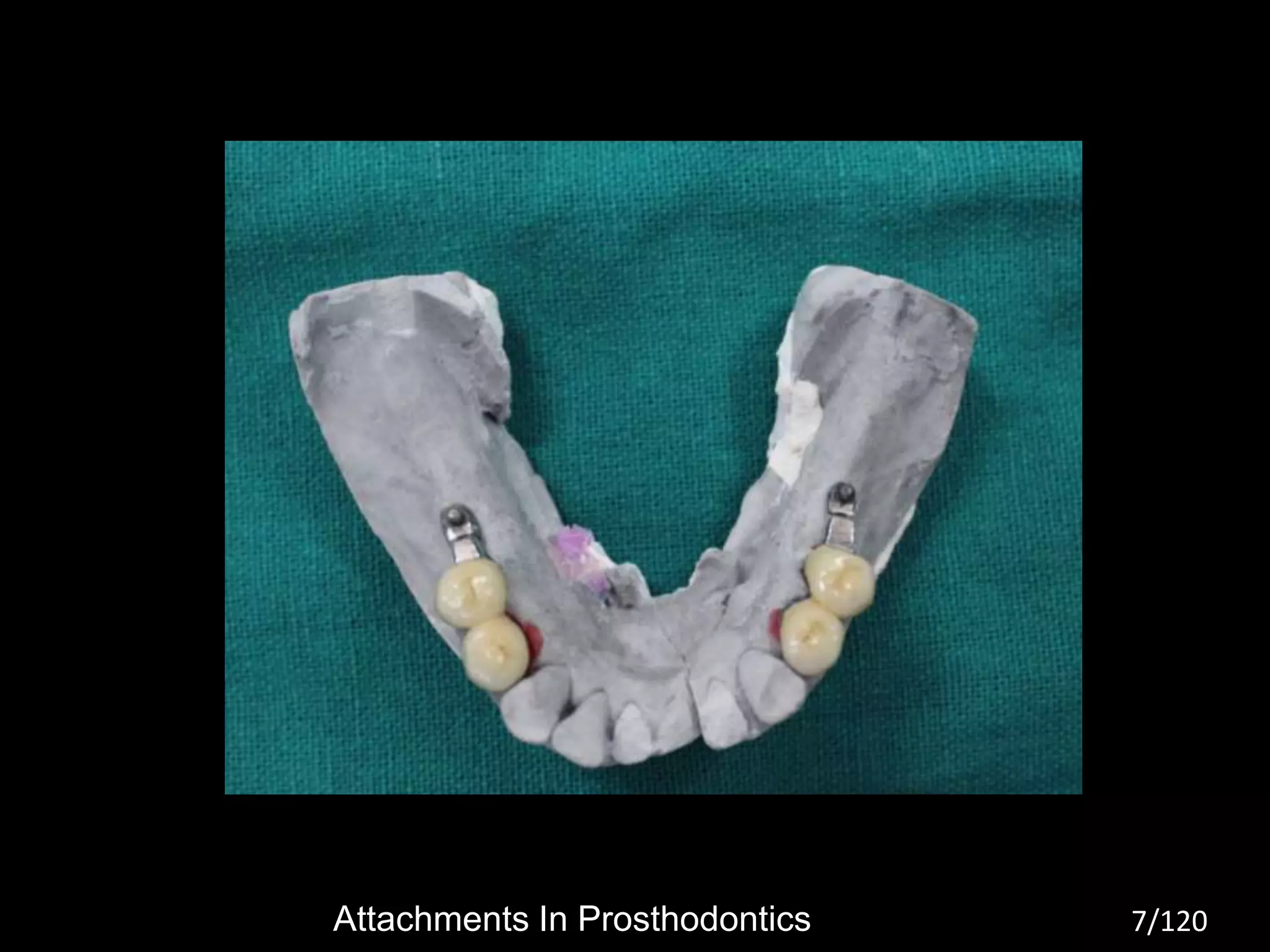 Attachments In Prosthodontics | PPTX