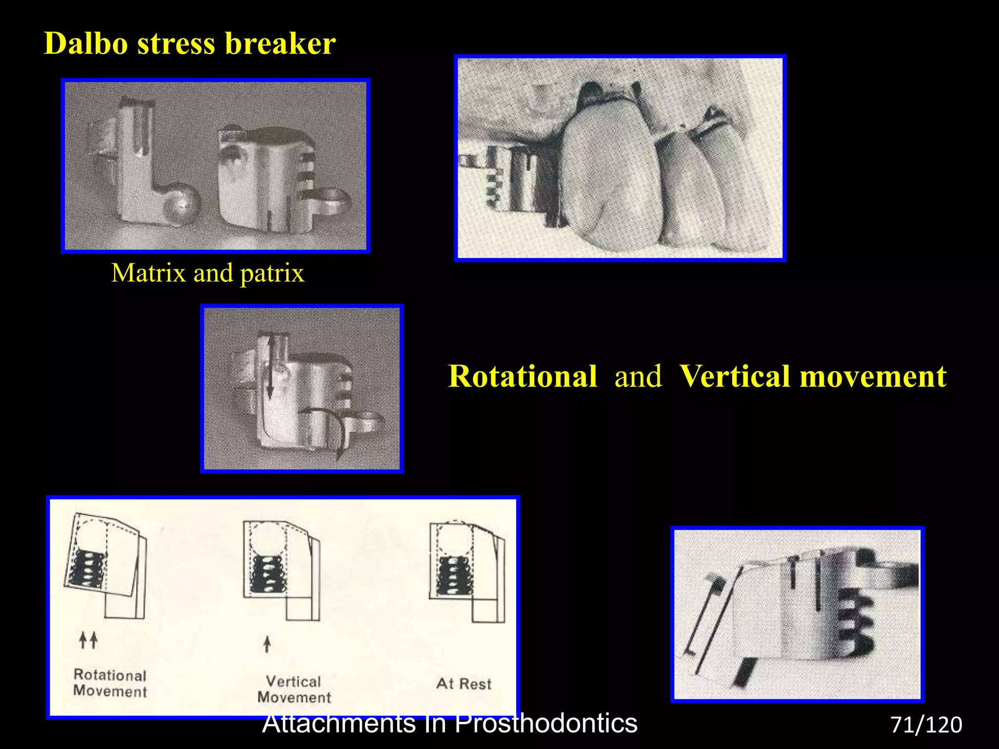 Attachments In Prosthodontics | PPTX