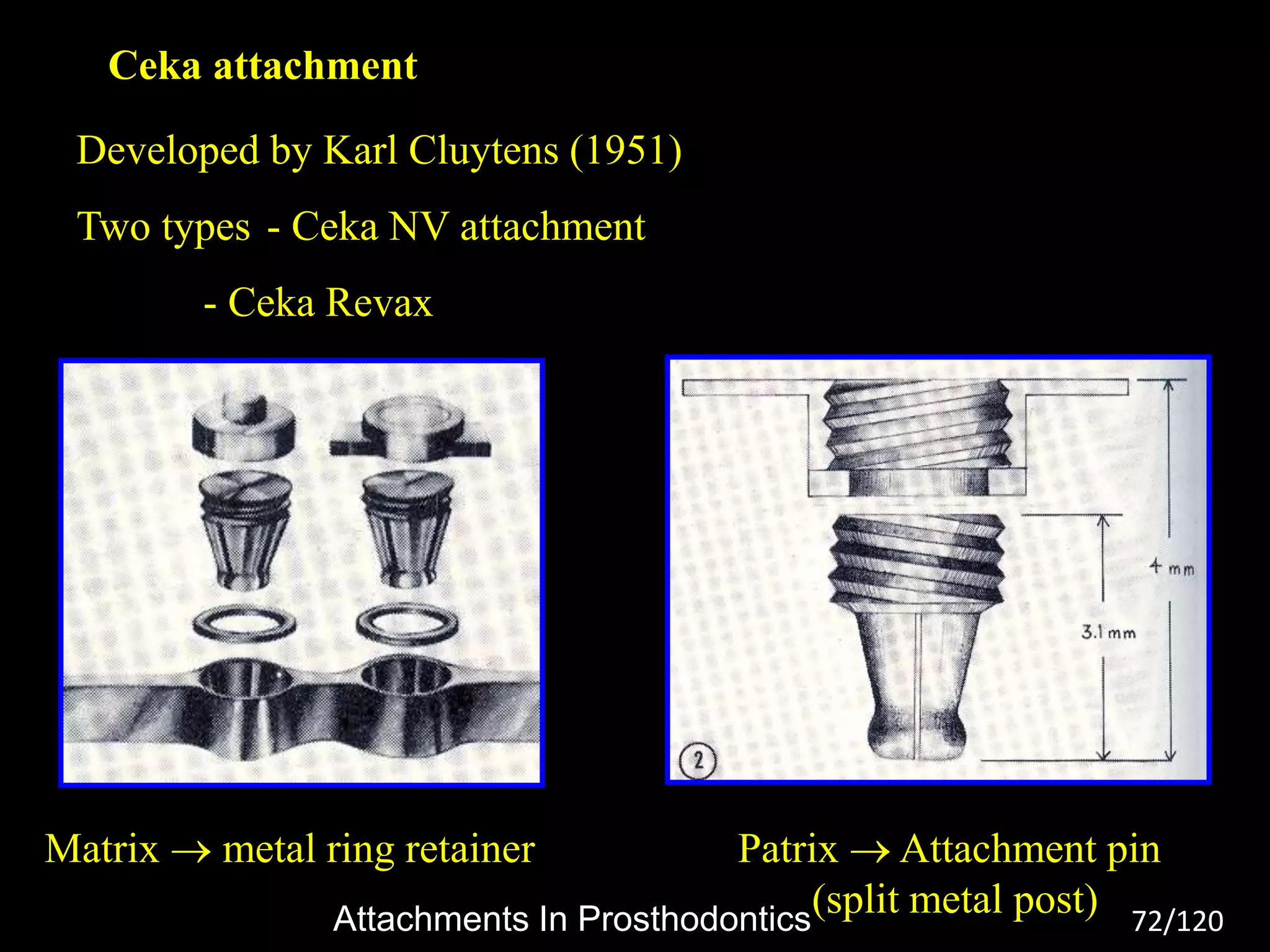 Attachments In Prosthodontics | PPTX