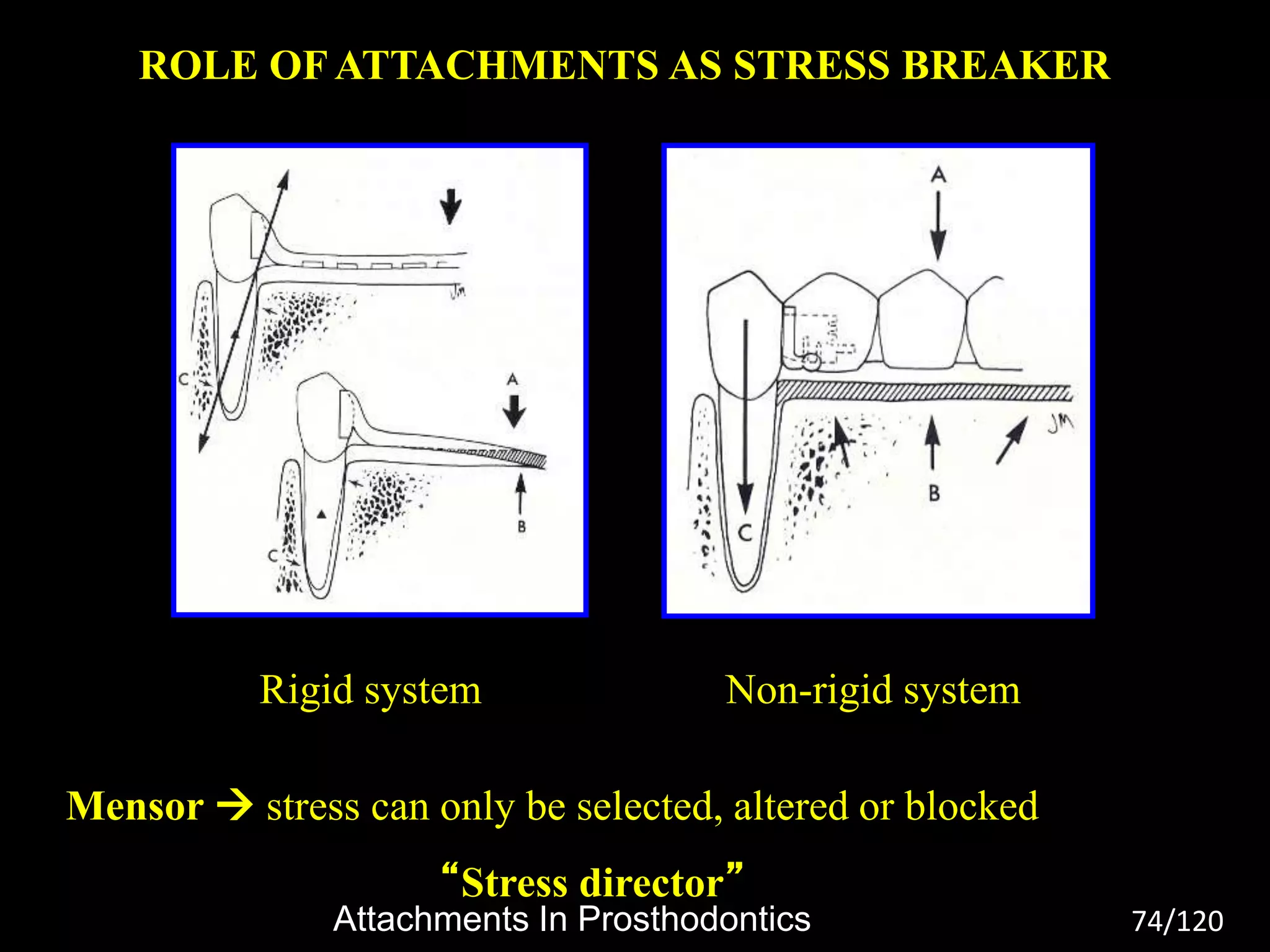 Attachments In Prosthodontics | PPTX
