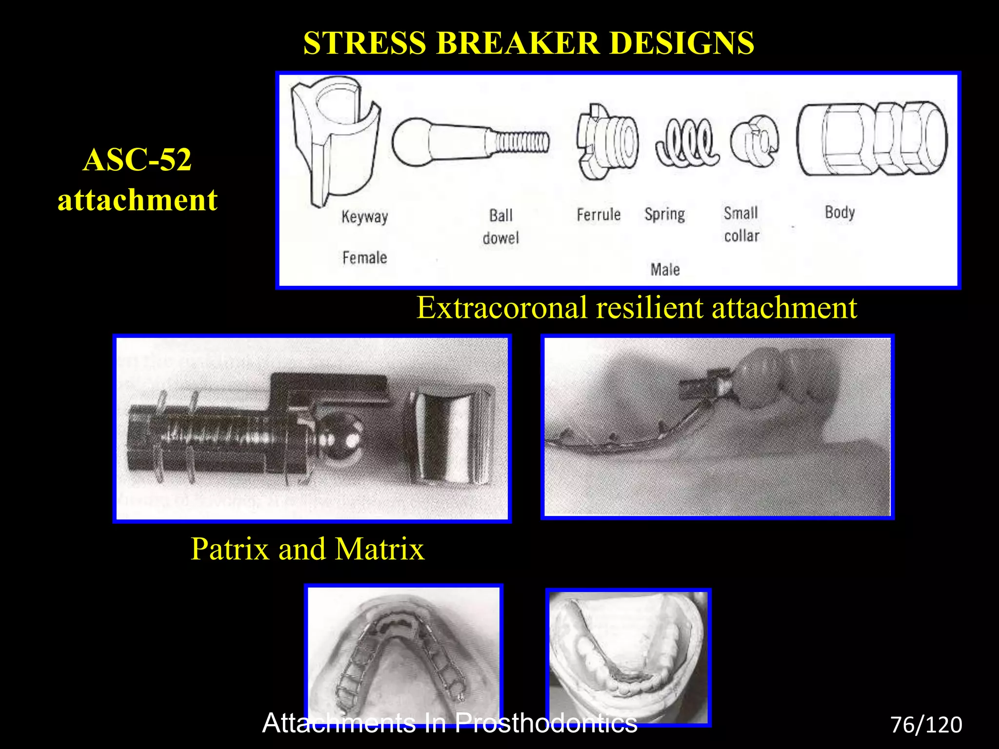 Attachments In Prosthodontics | PPTX