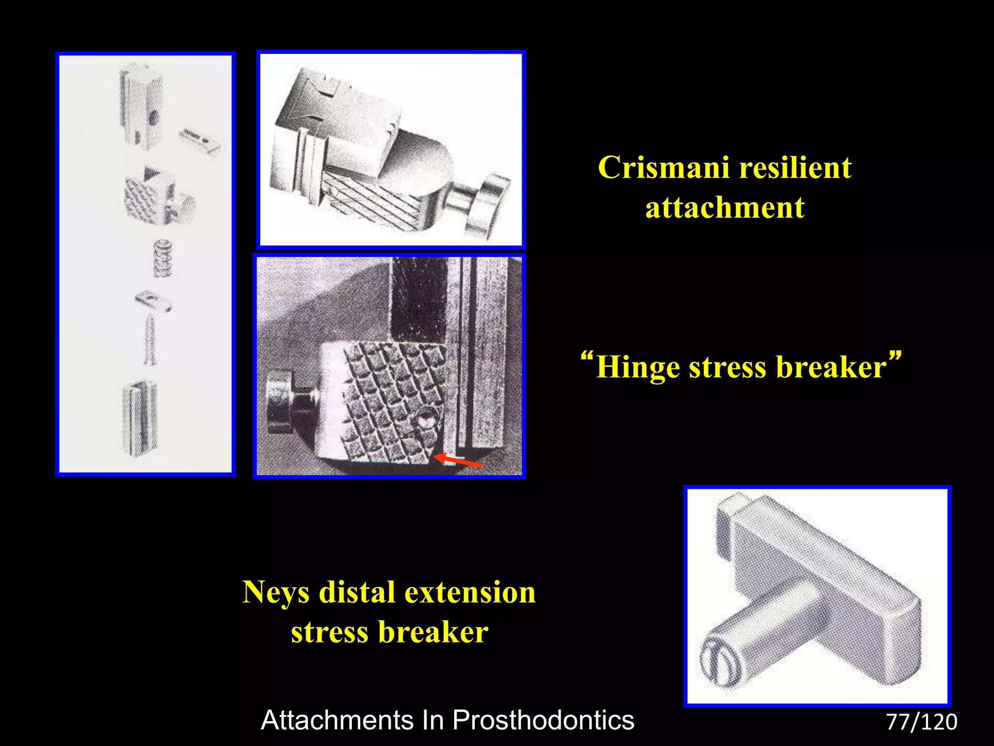 Attachments In Prosthodontics | PPTX