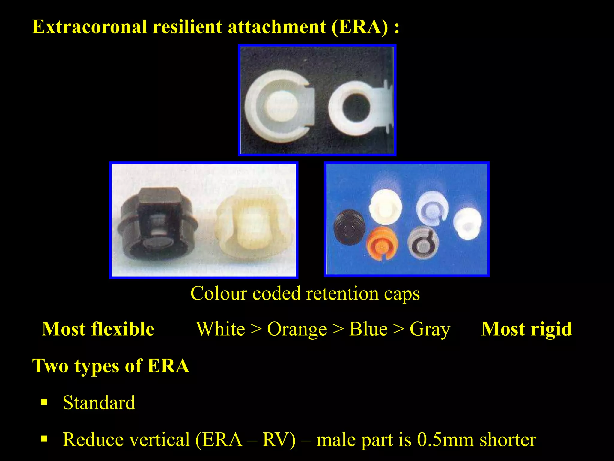 Attachments In Prosthodontics | PPTX