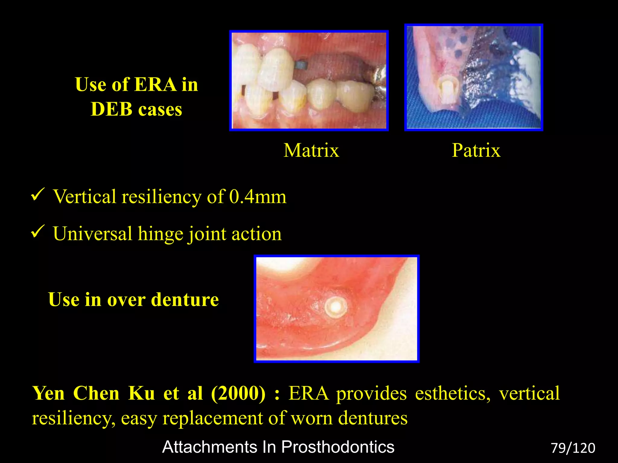 Attachments In Prosthodontics | PPTX