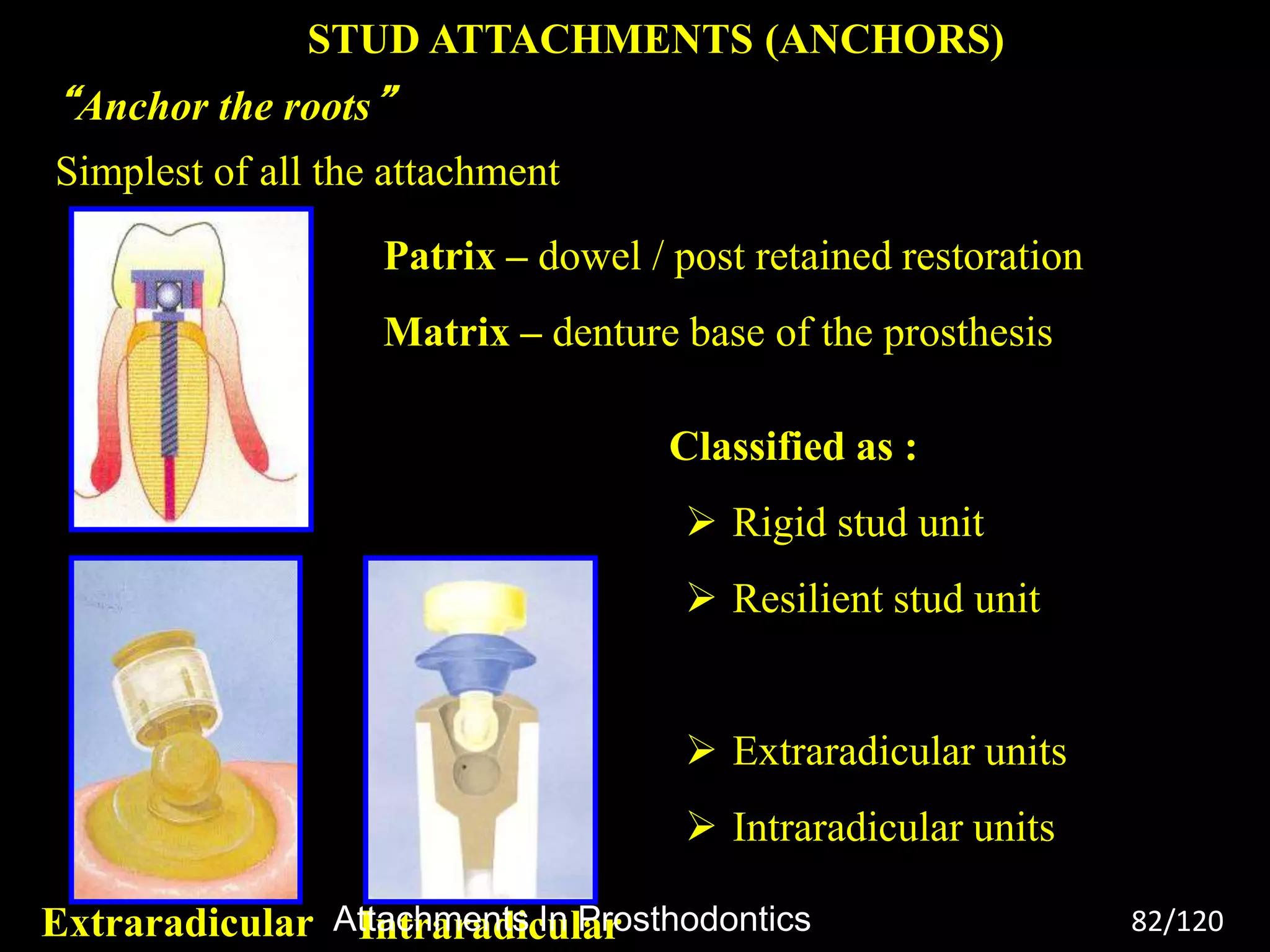 Attachments In Prosthodontics | PPTX