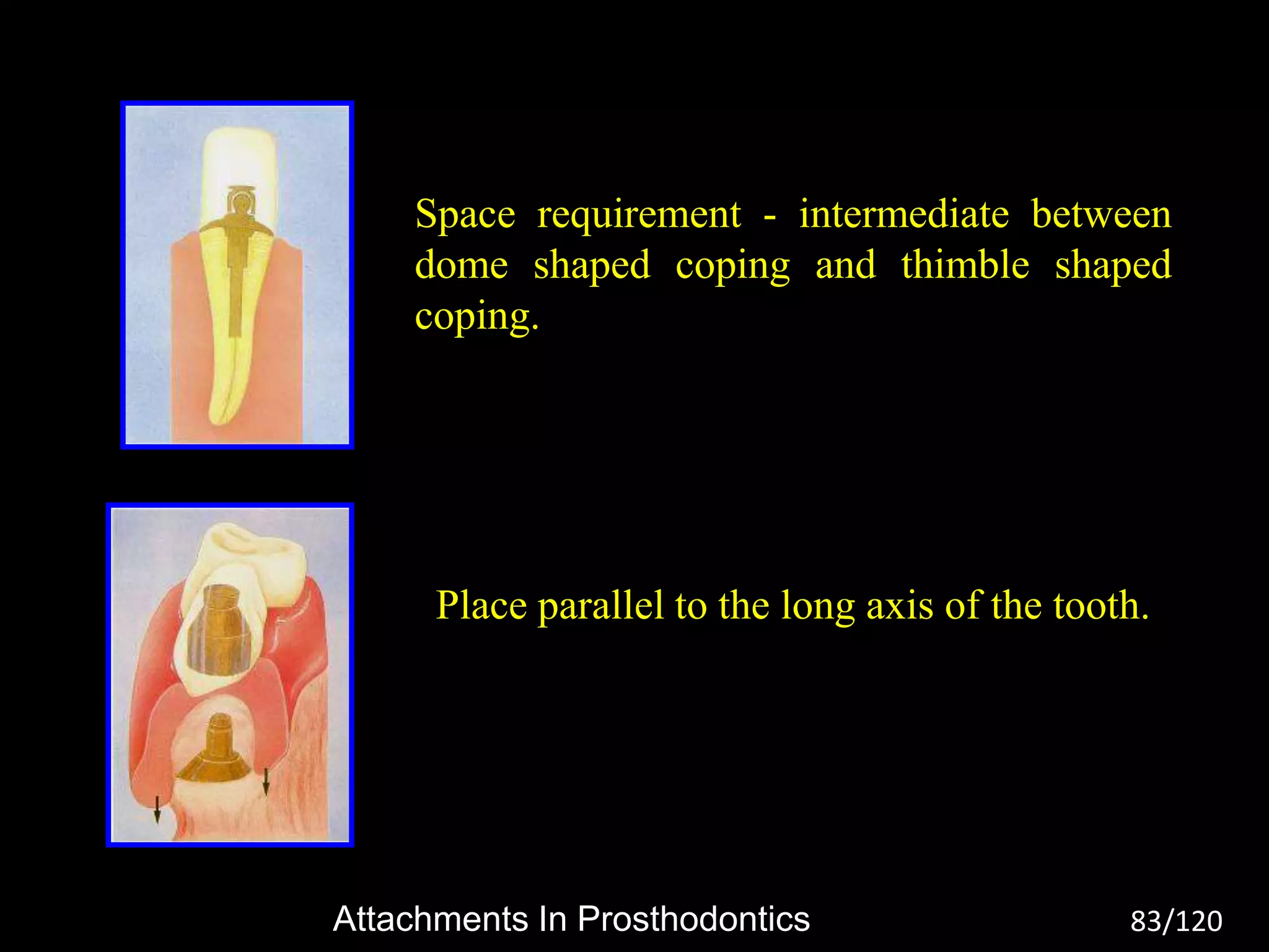 Attachments In Prosthodontics | PPTX