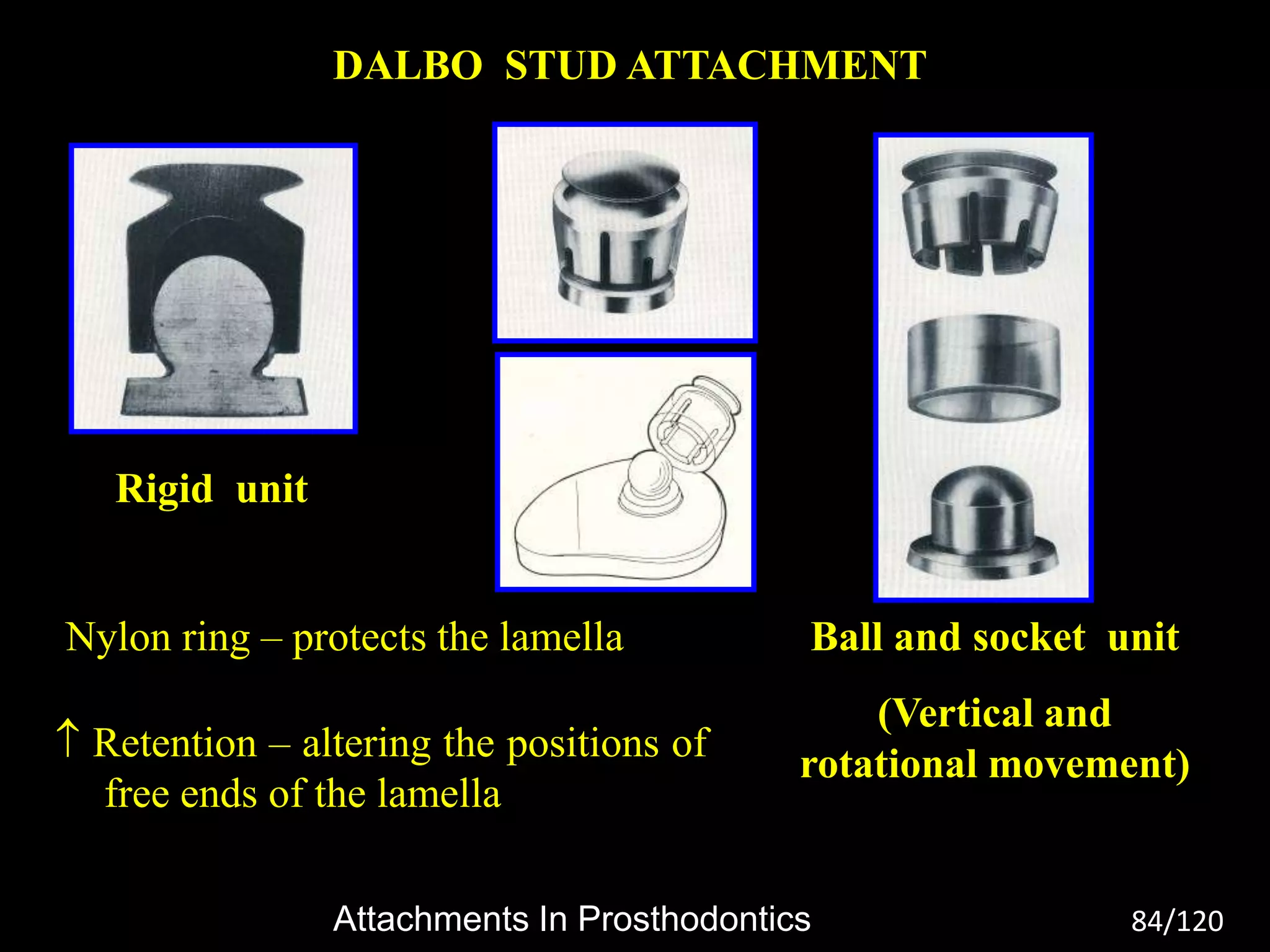 Attachments In Prosthodontics | PPTX