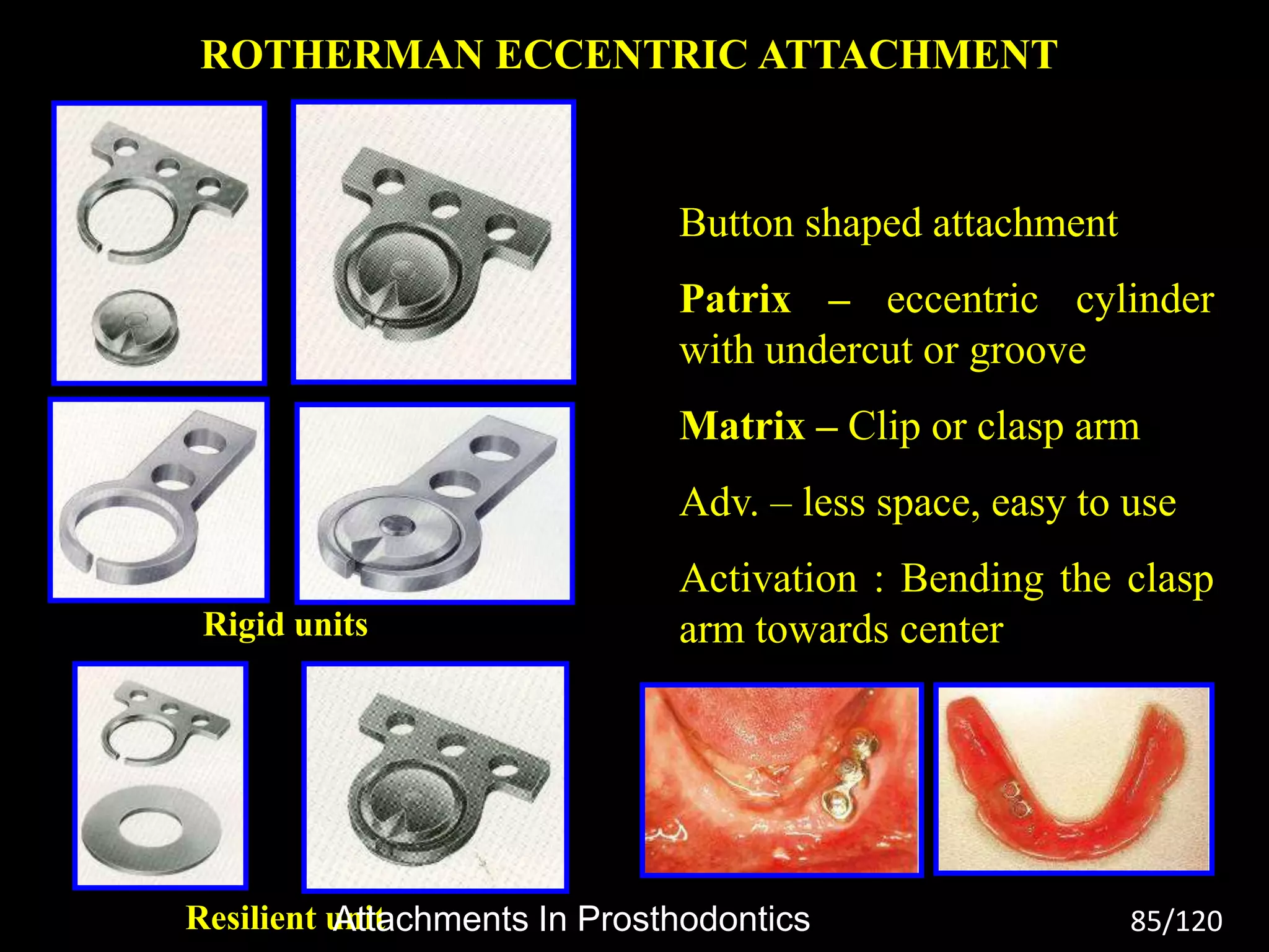 Attachments In Prosthodontics | PPTX