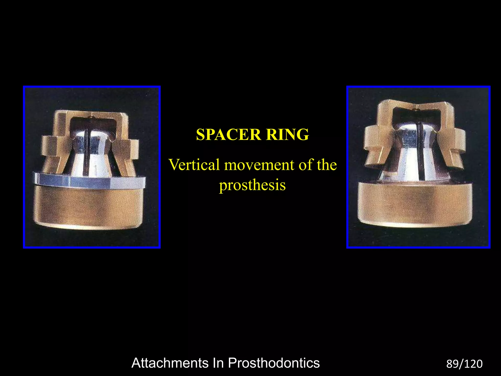Attachments In Prosthodontics | PPTX