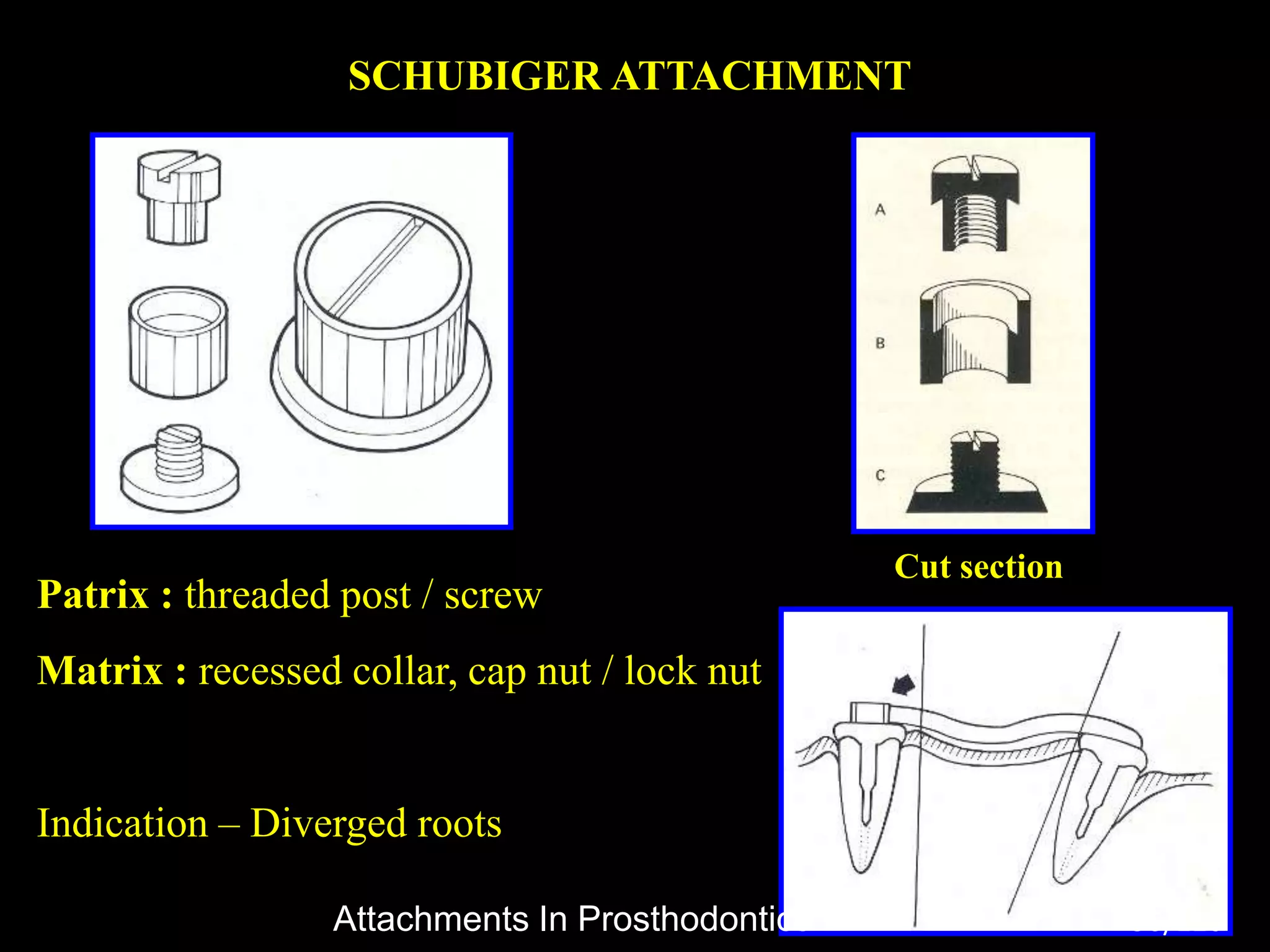 Attachments In Prosthodontics | PPTX