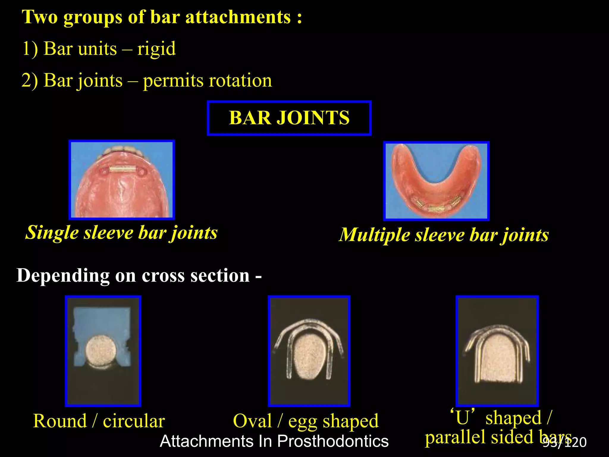 Attachments In Prosthodontics | PPTX