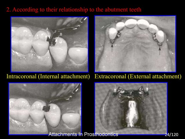 Attachments In Prosthodontics | PPTX