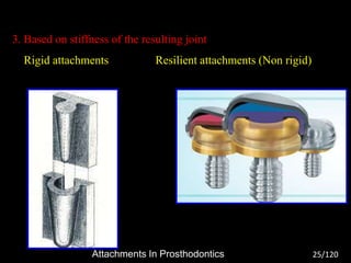 Attachments In Prosthodontics | PPTX