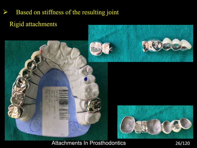 Attachments In Prosthodontics | PPTX