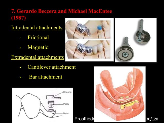 Attachments In Prosthodontics | PPTX