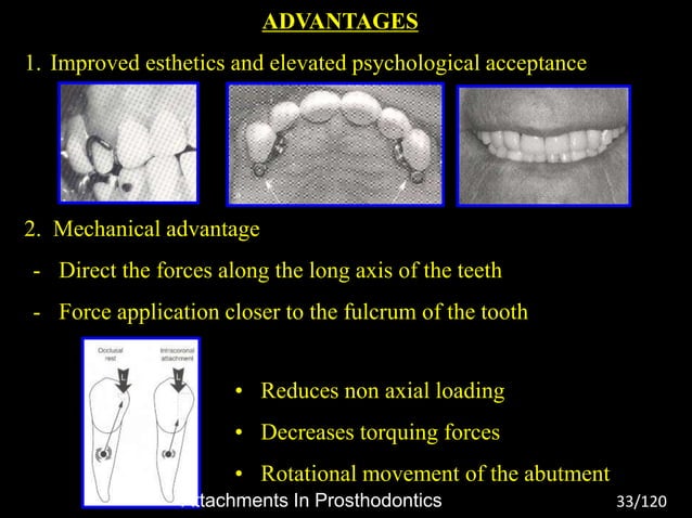 Attachments In Prosthodontics | PPTX