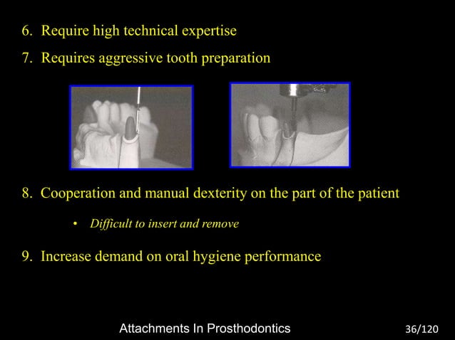 Attachments In Prosthodontics | PPTX