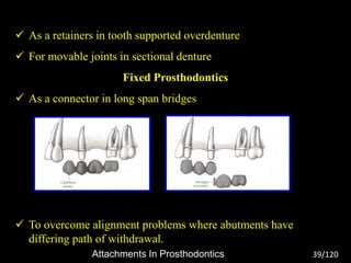 Attachments In Prosthodontics | PPTX