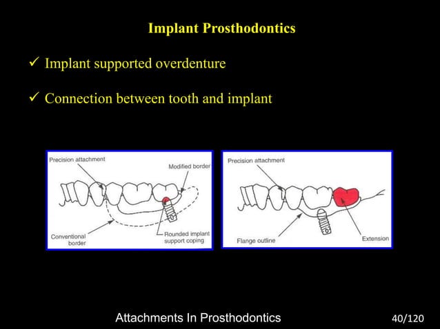 Attachments In Prosthodontics | PPTX