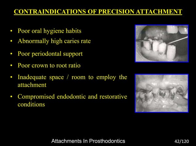 Attachments In Prosthodontics | PPT