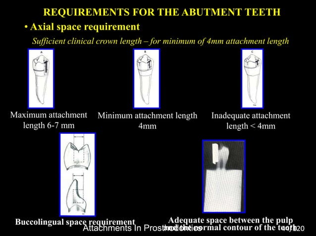 Attachments In Prosthodontics | PPTX