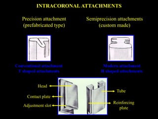 Attachments In Prosthodontics | PPTX
