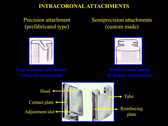 Attachments In Prosthodontics | PPTX