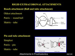Attachments In Prosthodontics | PPTX