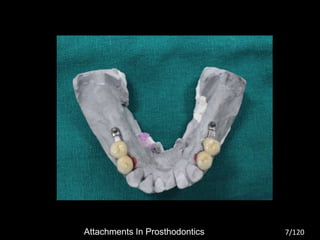 Attachments In Prosthodontics | PPTX