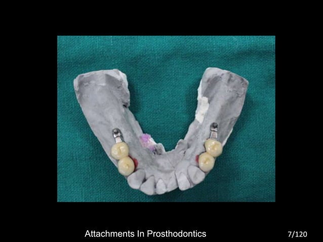 Attachments In Prosthodontics | PPTX