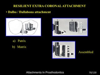 Attachments In Prosthodontics | PPTX