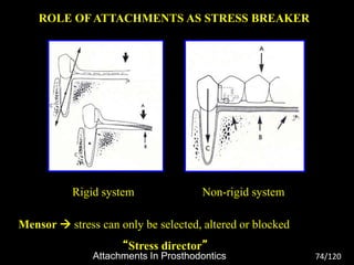 Attachments In Prosthodontics | PPTX
