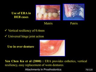 Attachments In Prosthodontics | PPTX