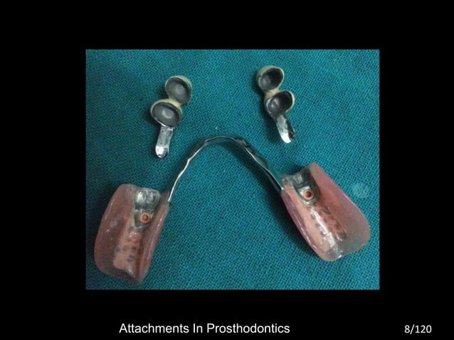 Attachments In Prosthodontics | PPTX