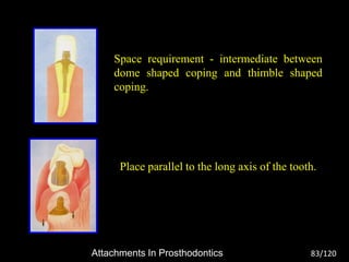 Attachments In Prosthodontics | PPTX