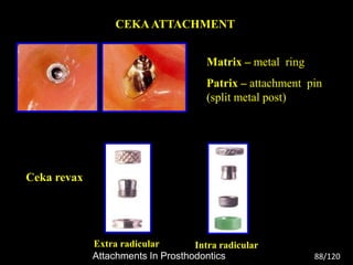Attachments In Prosthodontics | PPTX