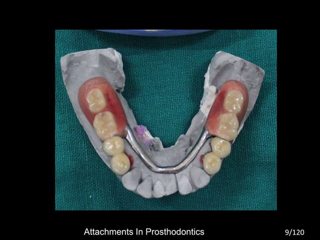 Attachments In Prosthodontics | PPTX