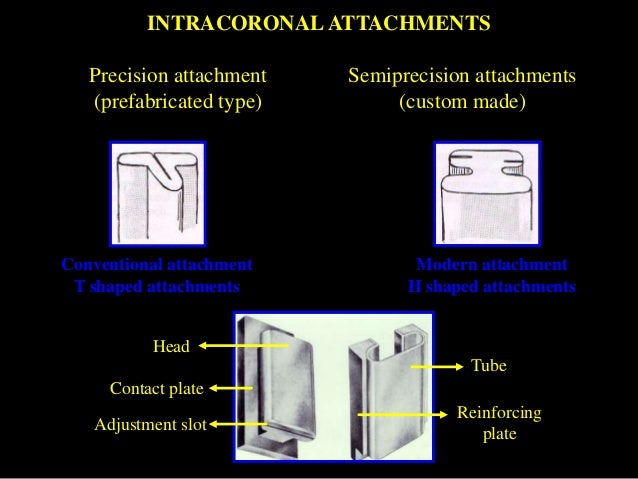 Attachments In Prosthodontics